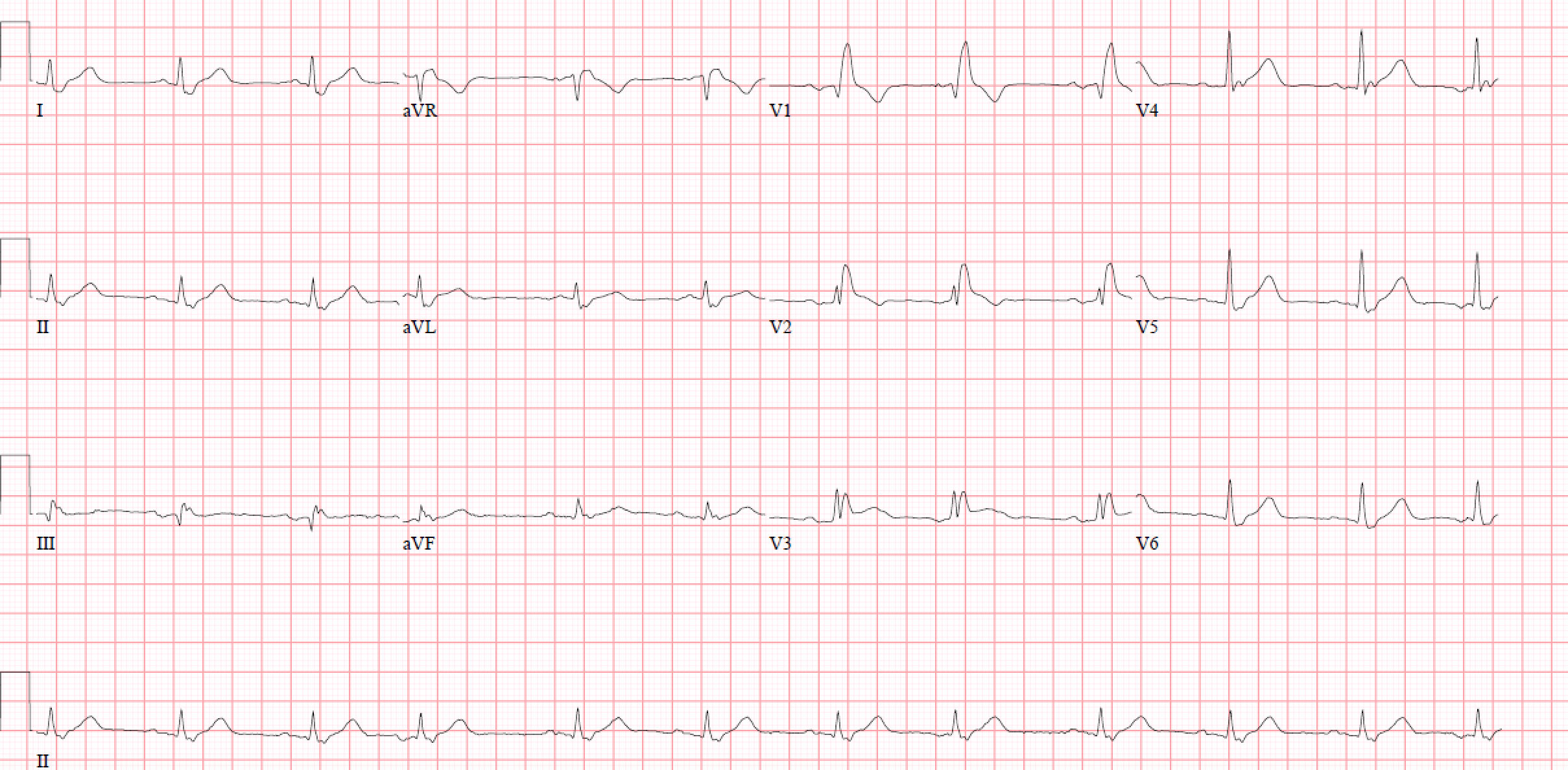 Thrombolysis In STEMI Cardio Guide