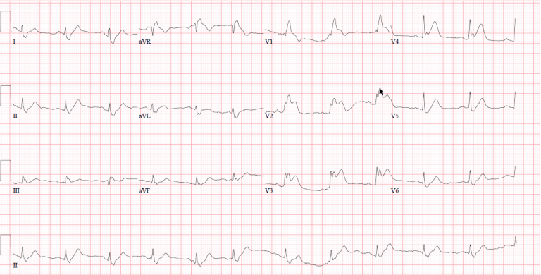 ST Elevation MI (STEMI) – Cardio Guide