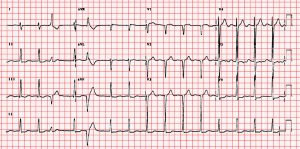 Right Ventricular Hypertrophy - Cardio Guide