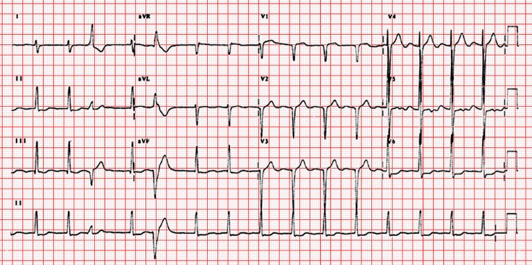 Right Ventricular Hypertrophy - Cardio Guide