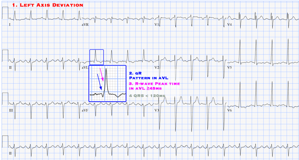Bundle Branch Blocks - Cardio Guide