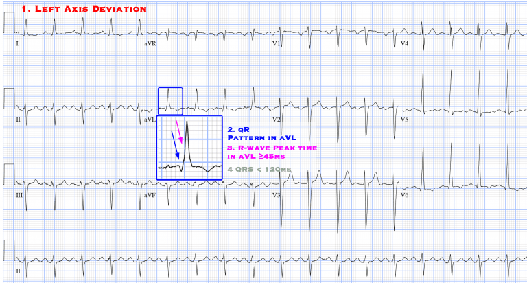 Bundle Branch Blocks - Cardio Guide
