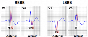 Bundle Branch Blocks - Cardio Guide