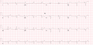 Sgarbossa Criteria - Cardio Guide