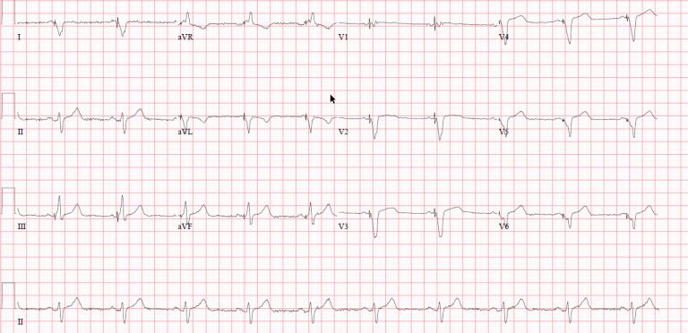 Sgarbossa Criteria - Cardio Guide