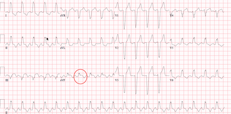 Sgarbossa Criteria - Cardio Guide