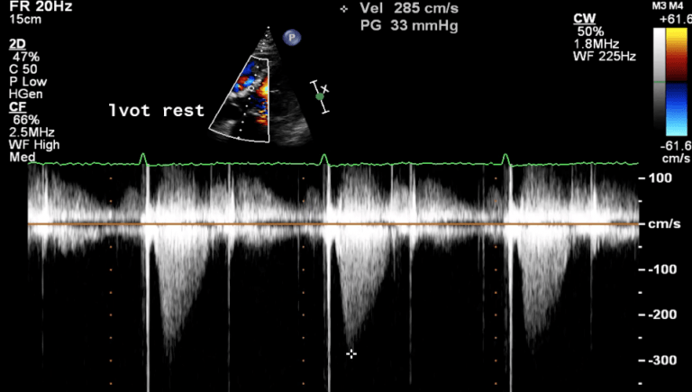 Hypertrophic Cardiomyopathy - Cardio Guide