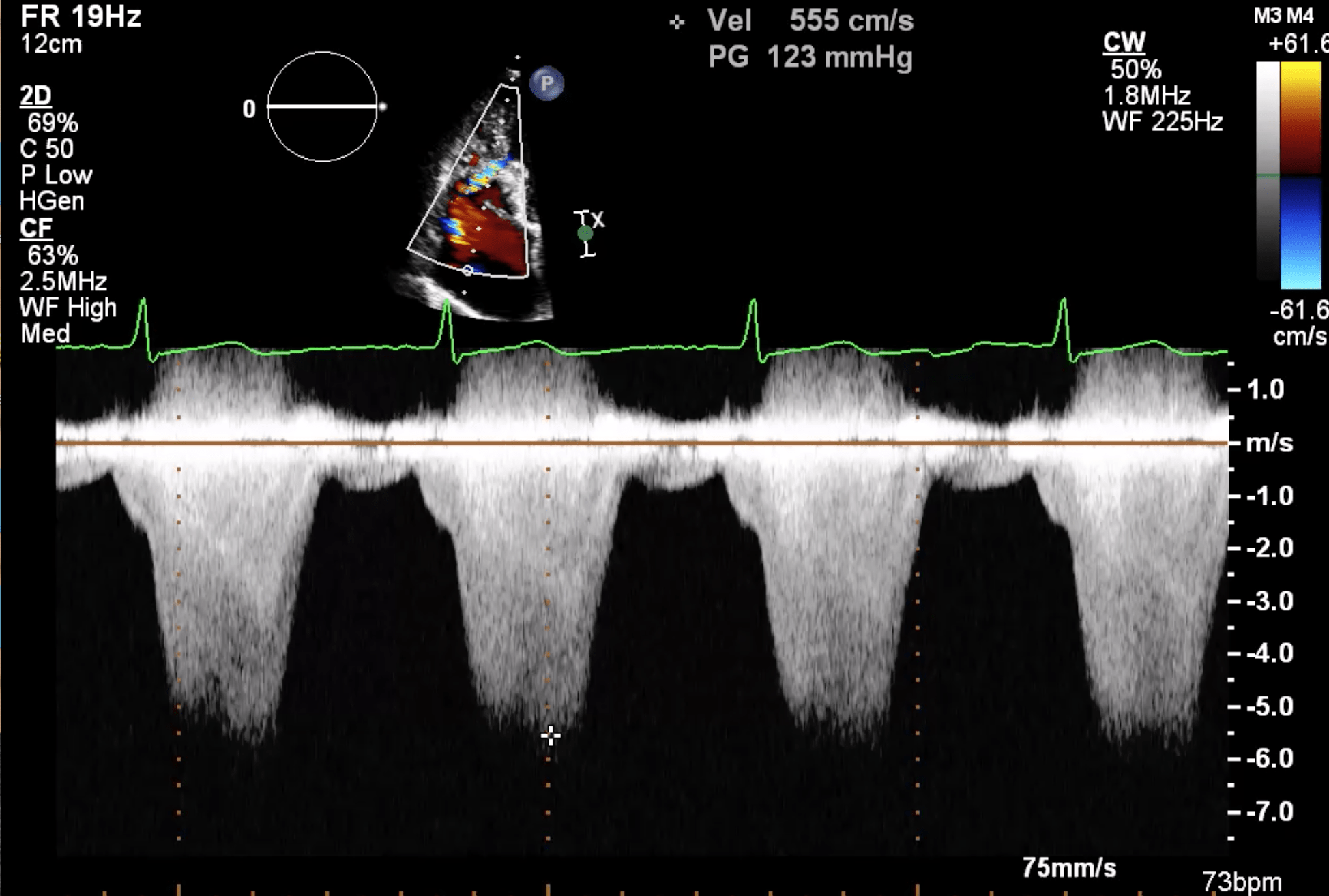 Ventricular Septal Defect Vsd Cardio Guide