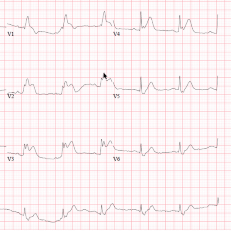 ECG Topics – Cardio Guide