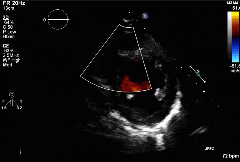 Ventricular Septal Defect (VSD) - Cardio Guide