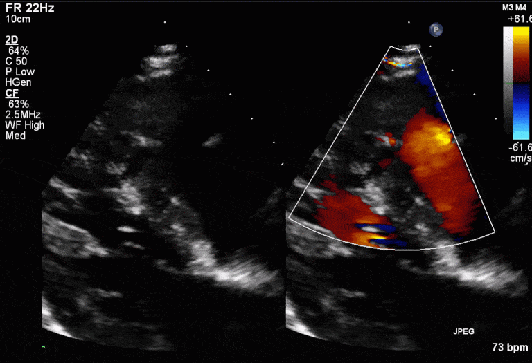 Ventricular Septal Defect (VSD) - Cardio Guide
