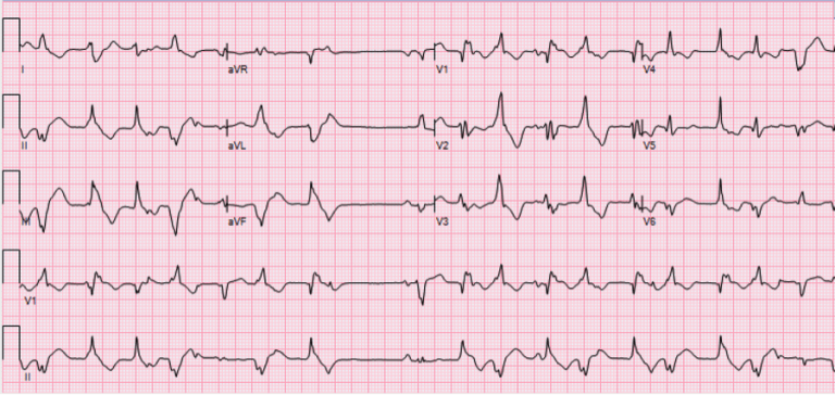 Bidirectional Ventricular Tachycardia - Cardio Guide