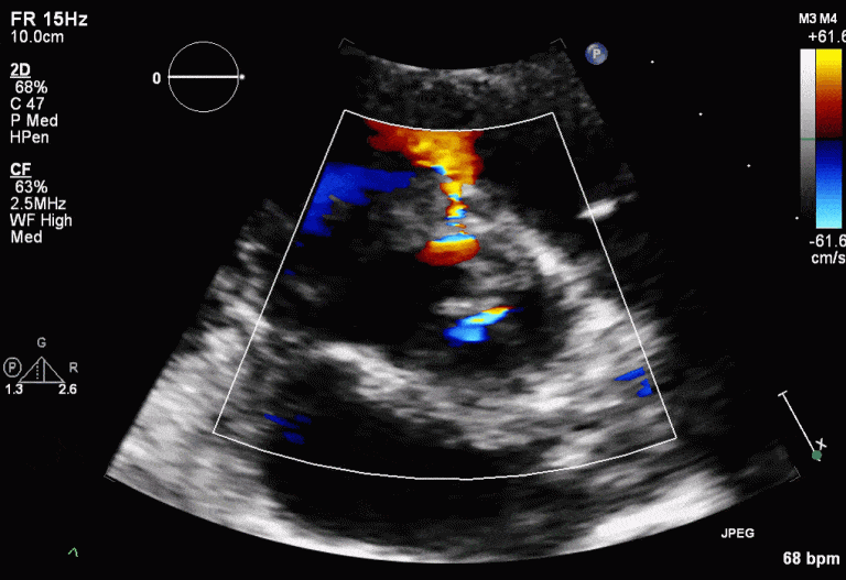 Ventricular Septal Defect (VSD) - Cardio Guide