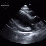 Pericarditis – Cardio Guide