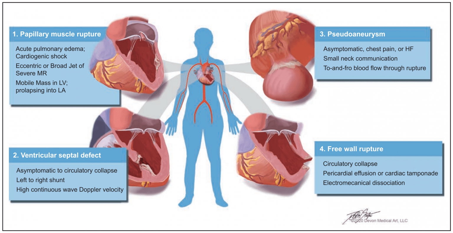 Complications of Myocardial Infarction - Cardio Guide