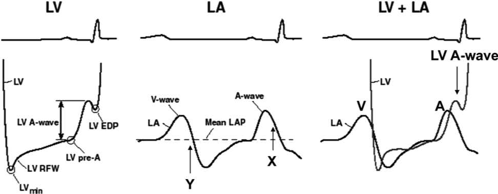 Diastolic Dysfunction – Cardio Guide