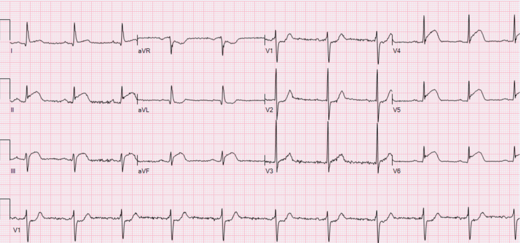 Inferior STEMI #1 - Cardio Guide