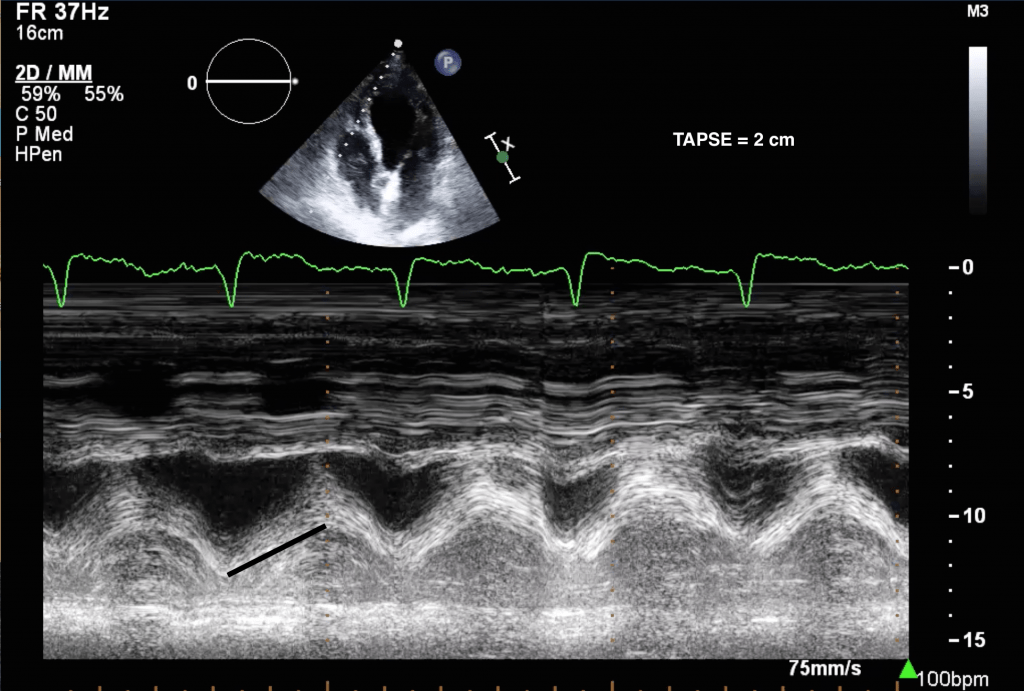 Complications of Myocardial Infarction - Cardio Guide