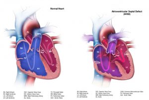 Complete AV Septal Defect - Cardio Guide