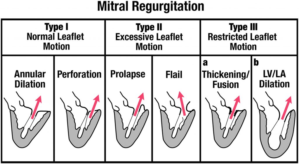 Mitral Regurgitation Cardio Guide Mitral Regurgitation Cardio Guide