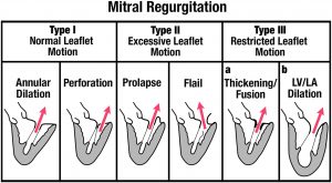 Mitral Regurgitation - Cardio Guide