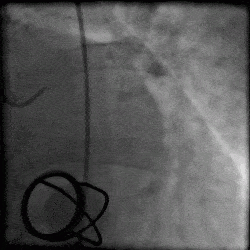 Starr-Edwards Mitral Valve - Cardio Guide