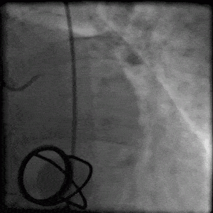 Starr-Edwards Mitral Valve - Cardio Guide