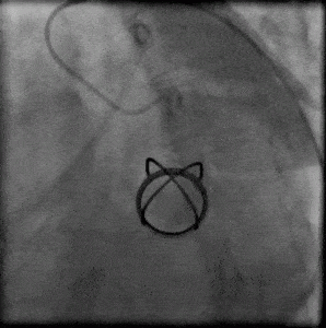 Starr-Edwards Mitral Valve - Cardio Guide