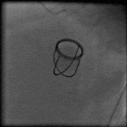 Starr-Edwards Mitral Valve - Cardio Guide