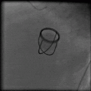 Starr-Edwards Mitral Valve - Cardio Guide