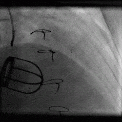 Starr-Edwards Mitral Valve - Cardio Guide