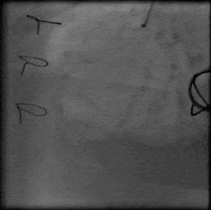 Starr-Edwards Mitral Valve - Cardio Guide