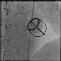 Starr-Edwards Mitral Valve - Cardio Guide