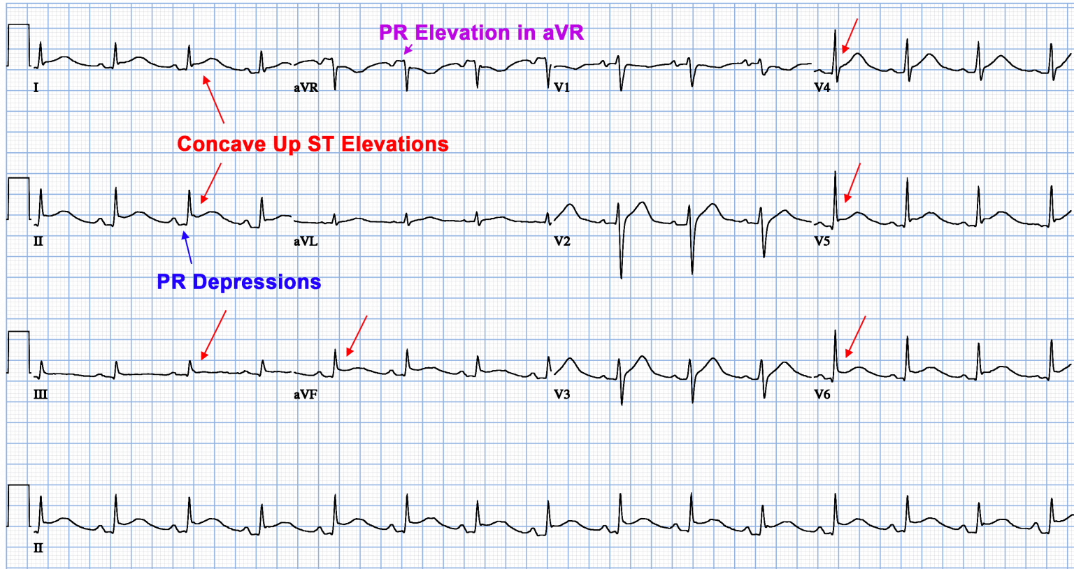 Pericarditis - Cardio Guide
