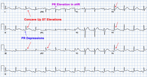 Pericarditis - Cardio Guide