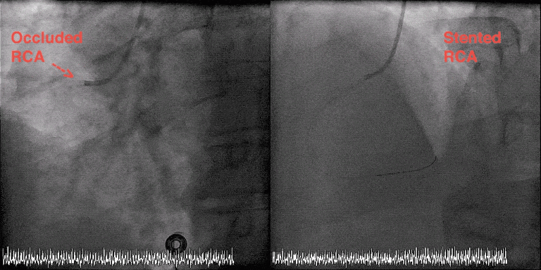 Cath: Practise Case #1 - Cardio Guide