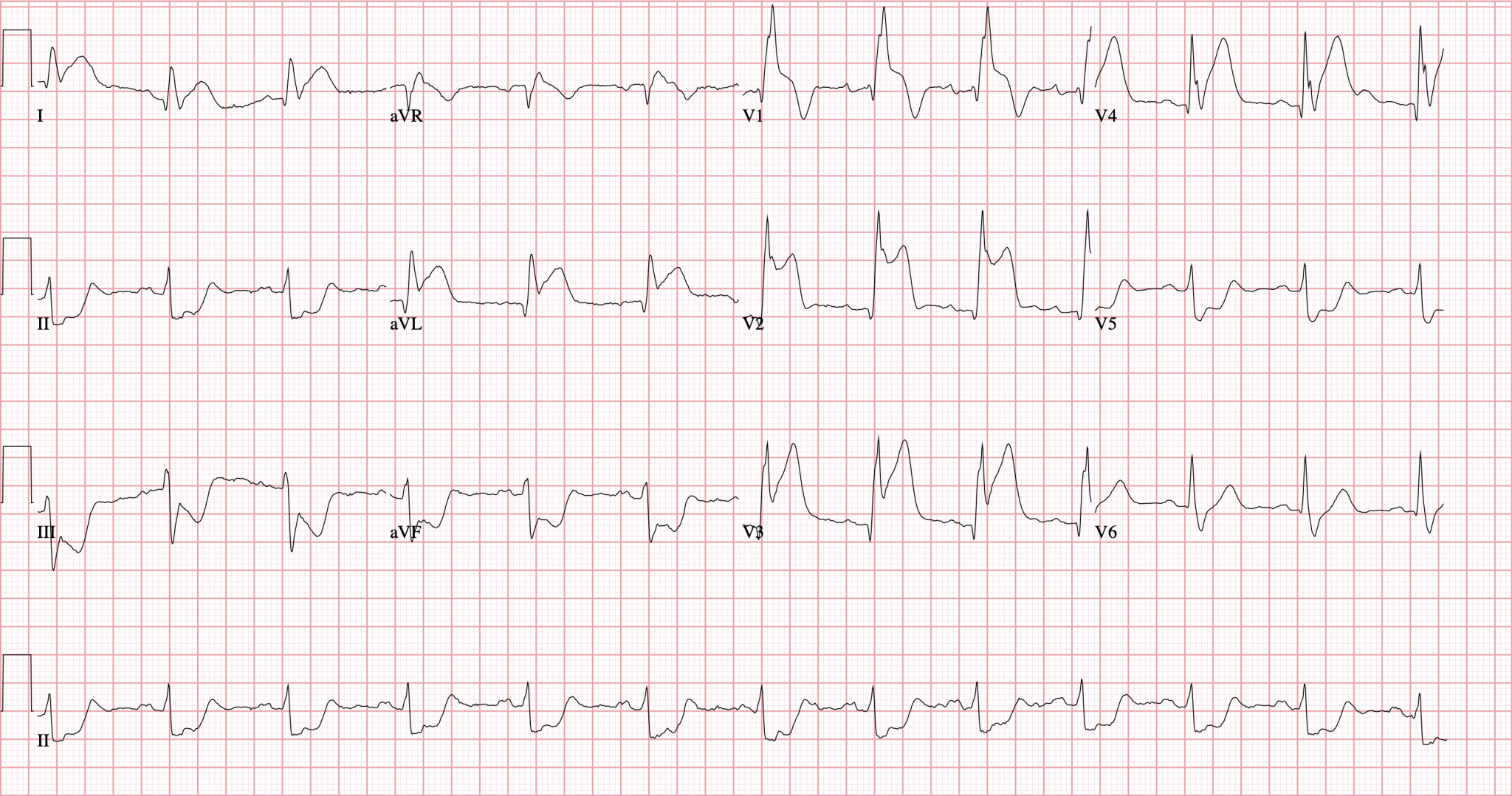 Acute Coronary Syndrome: ACE Inhibitors, Beta Blockers, MRAs (Companion ...