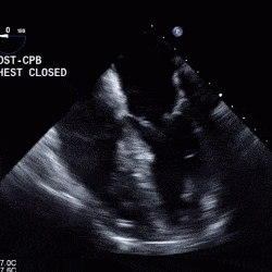 Aortic Dissection – Cardio Guide