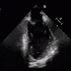 Non-Bacterial Thrombotic Endocarditis (NBTE) – Cardio Guide