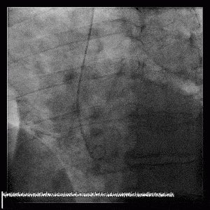 Aortic Dissection – Cardio Guide