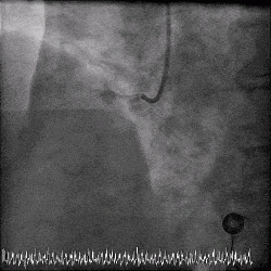 Aortic Dissection – Cardio Guide
