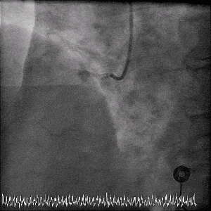 Aortic Dissection – Cardio Guide
