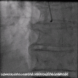 Aortic Dissection – Cardio Guide