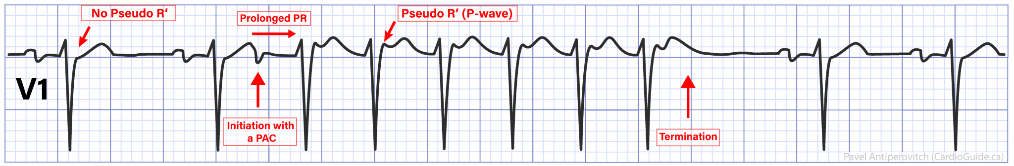 Narrow QRS Regular Tachycardia – Cardio Guide