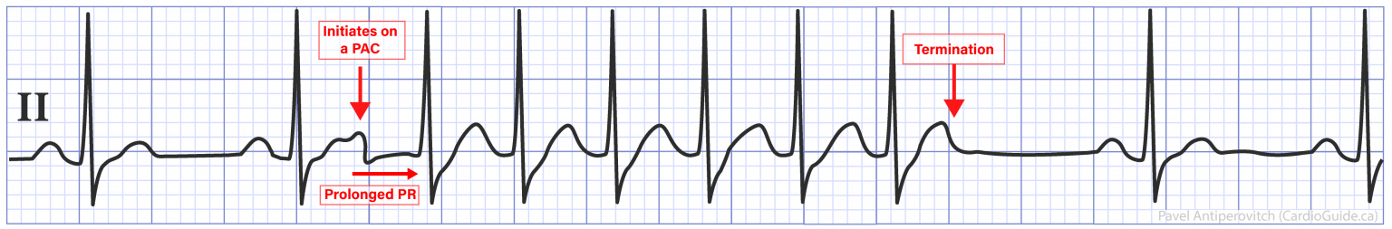 Narrow QRS Regular Tachycardia – Cardio Guide