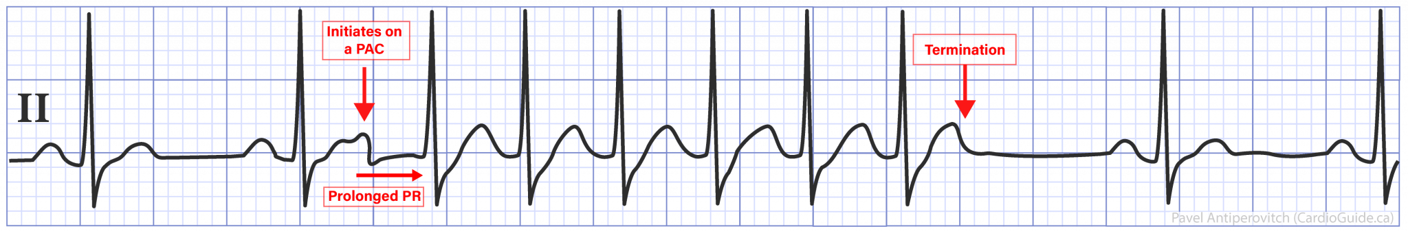 Narrow QRS Regular Tachycardia – Cardio Guide