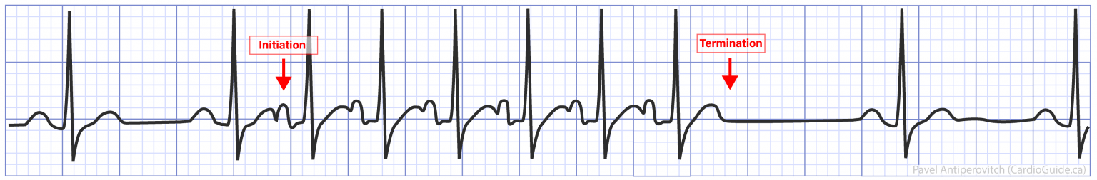 Atrial Tachycardia – Cardio Guide