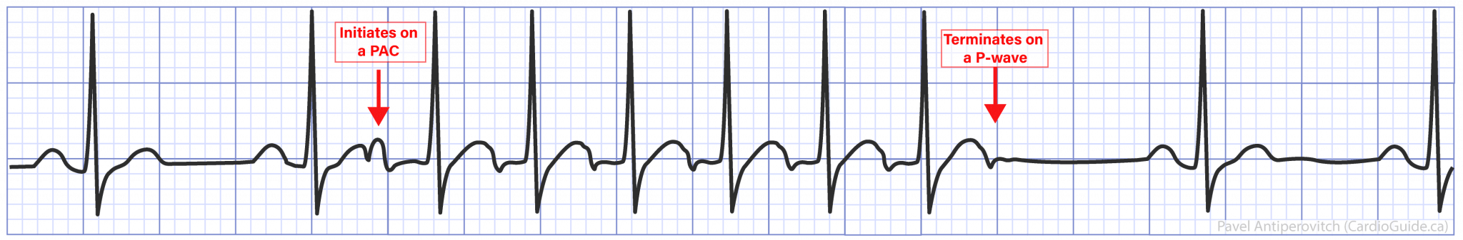 Atrial Tachycardia – Cardio Guide