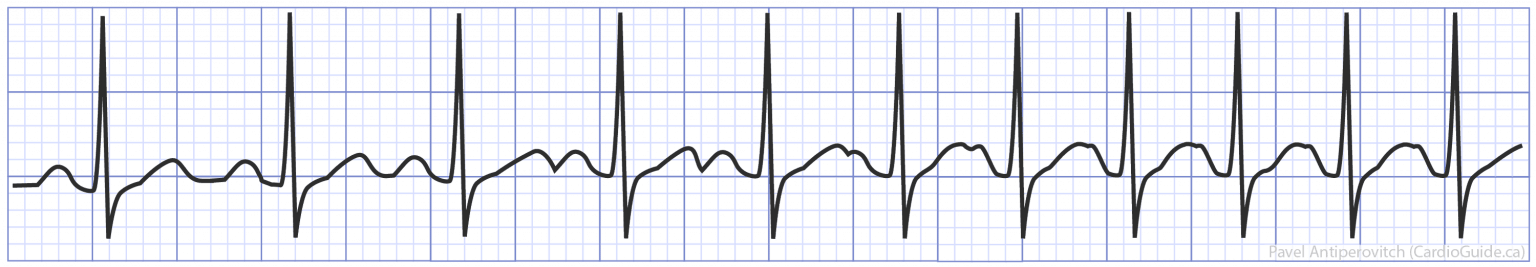 Sinus Tachycardia - Cardio Guide