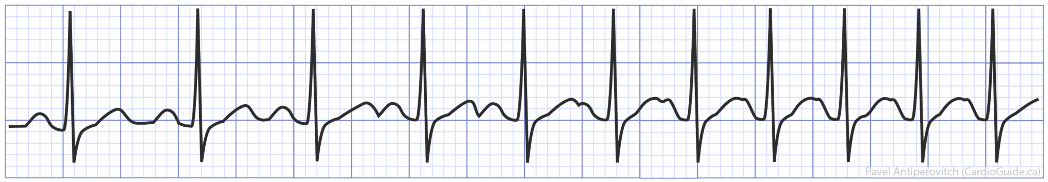 Sinus Tachycardia - Cardio Guide